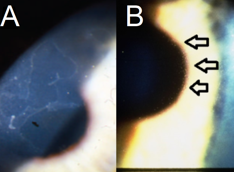 Corneal Dystrophy - MD Searchlight