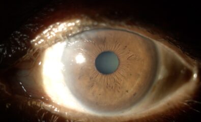 Pseudoexfoliation Syndrome and Glaucoma - MD Searchlight