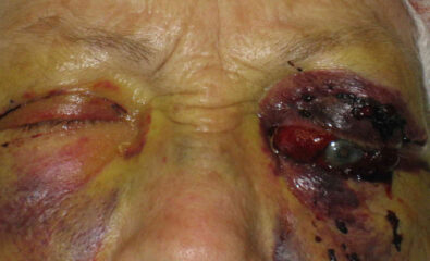 Retrobulbar Hematoma - MD Searchlight