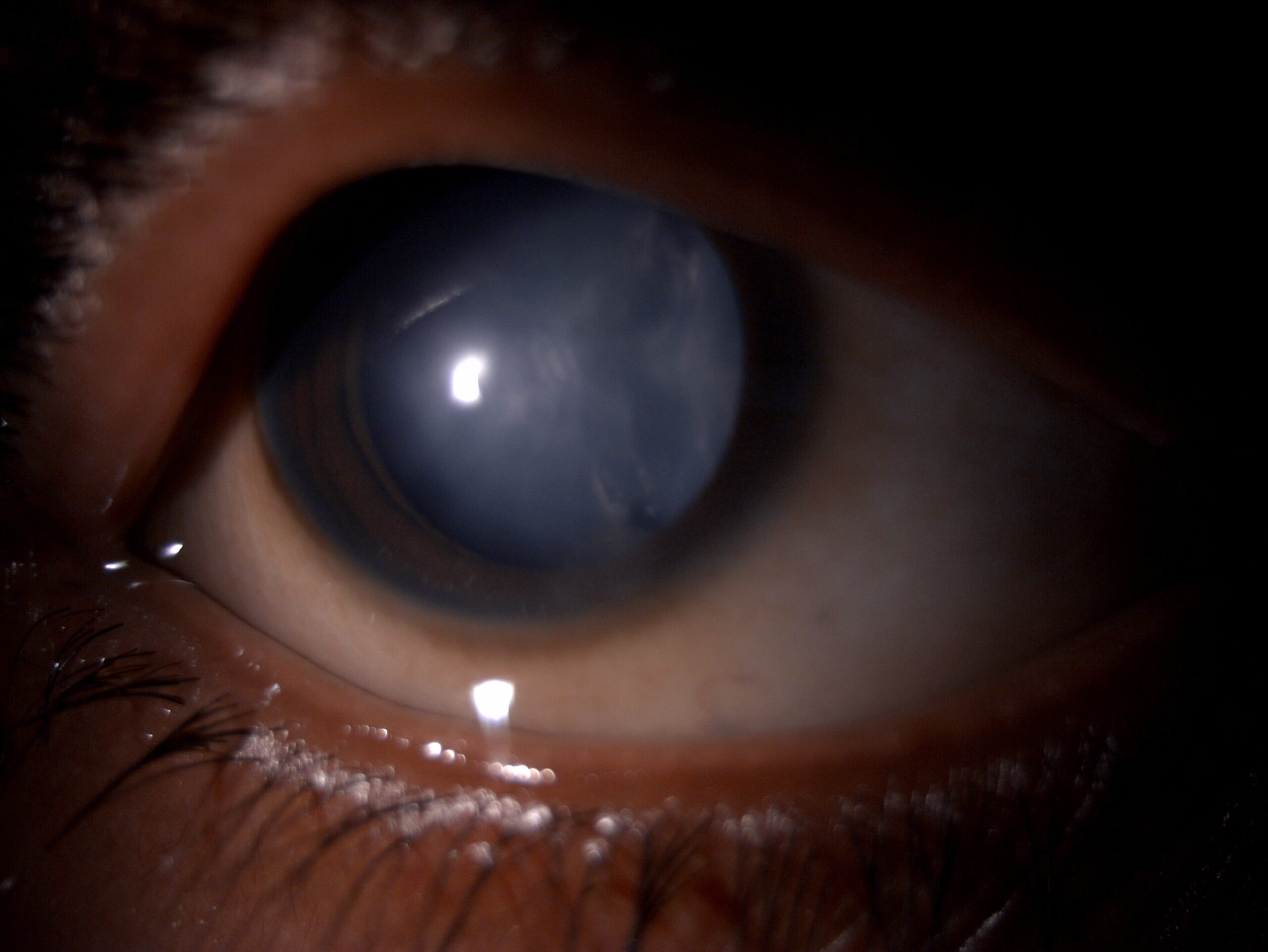 Charles Bonnet Syndrome - MD Searchlight