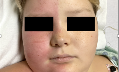 Harlequin Syndrome - MD Searchlight