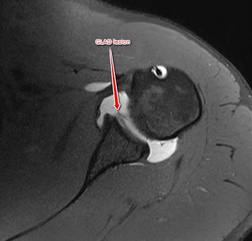 Glenolabral Articular Disruption (GLAD) - MD Searchlight
