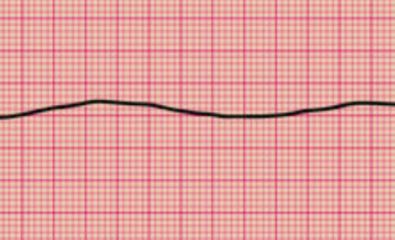 Asystole (Heart Attack) - MD Searchlight