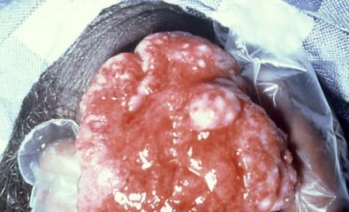 Granuloma Inguinale (Donovanosis) - MD Searchlight