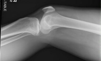 Hemarthrosis - MD Searchlight