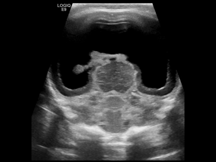 Holoprosencephaly - MD Searchlight