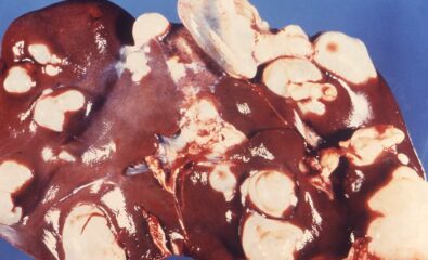 Echinococcus Granulosus (Tapeworm Infection) - MD Searchlight