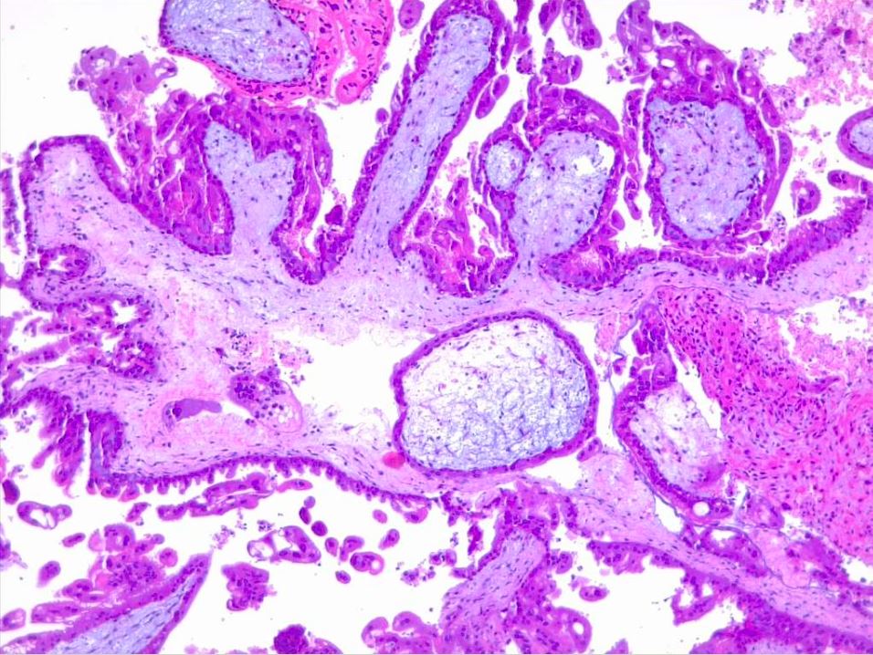 Hydatidiform Mole - MD Searchlight