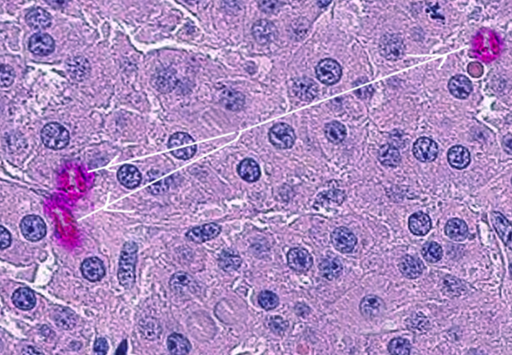 Leydig Cell Cancer - MD Searchlight