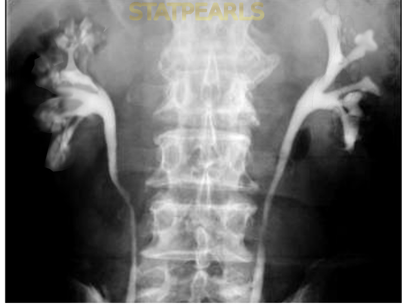 Medullary Sponge Kidney - MD Searchlight