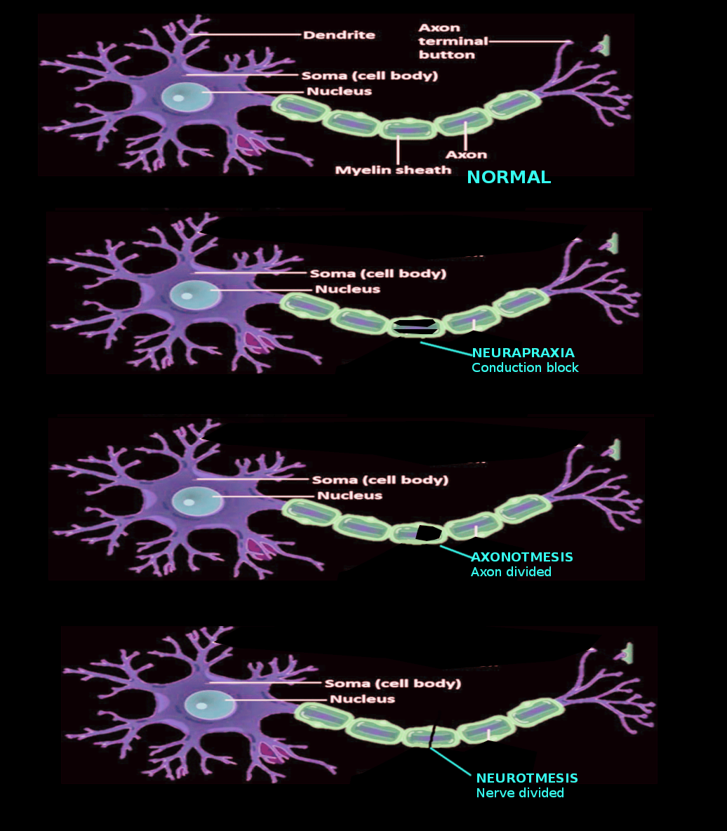 Acute Nerve Injury - MD Searchlight