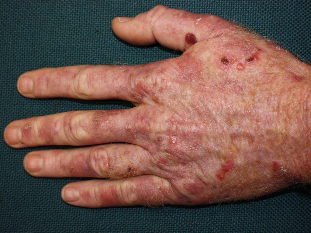 Acute Porphyria - MD Searchlight