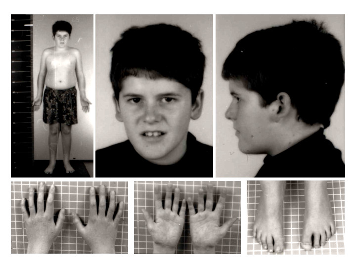 Prader-Willi Syndrome - MD Searchlight
