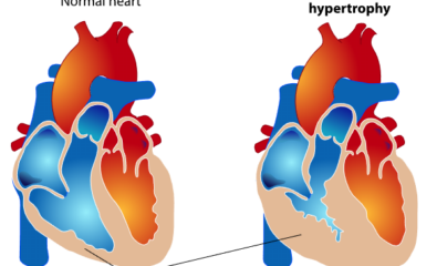 Right Ventricular Hypertrophy - MD Searchlight