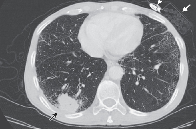 Squamous Cell Lung Cancer - MD Searchlight