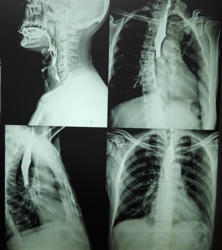 Caustic Ingestions - MD Searchlight