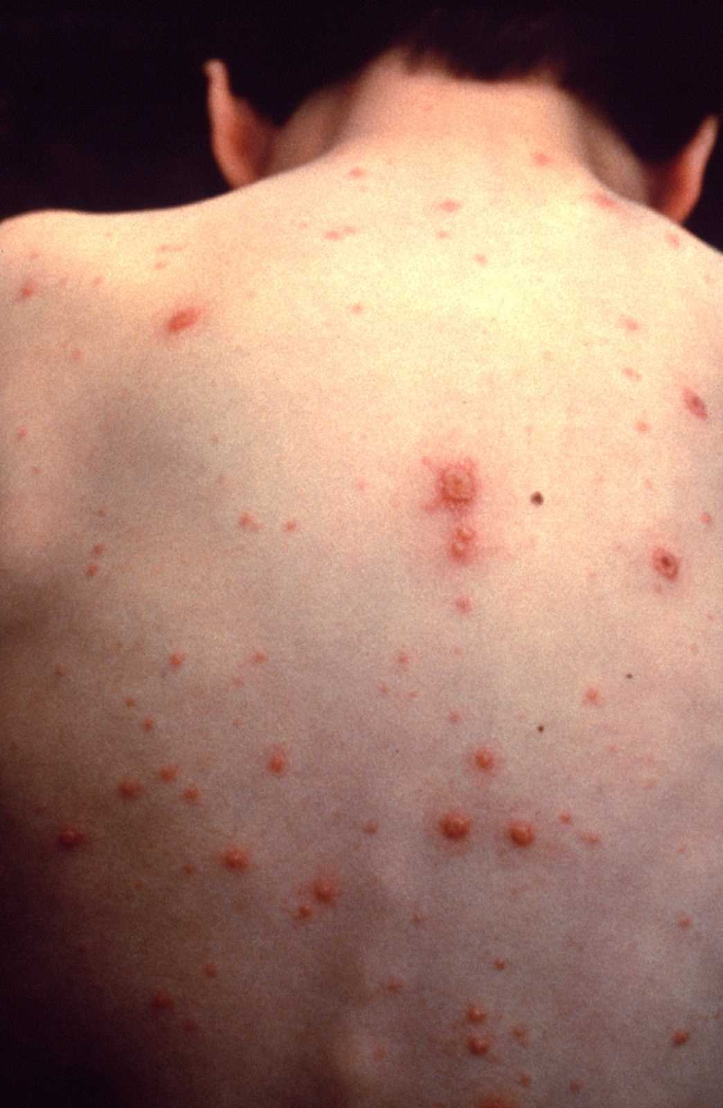 Varicella-Zoster Virus (Chickenpox) - MD Searchlight