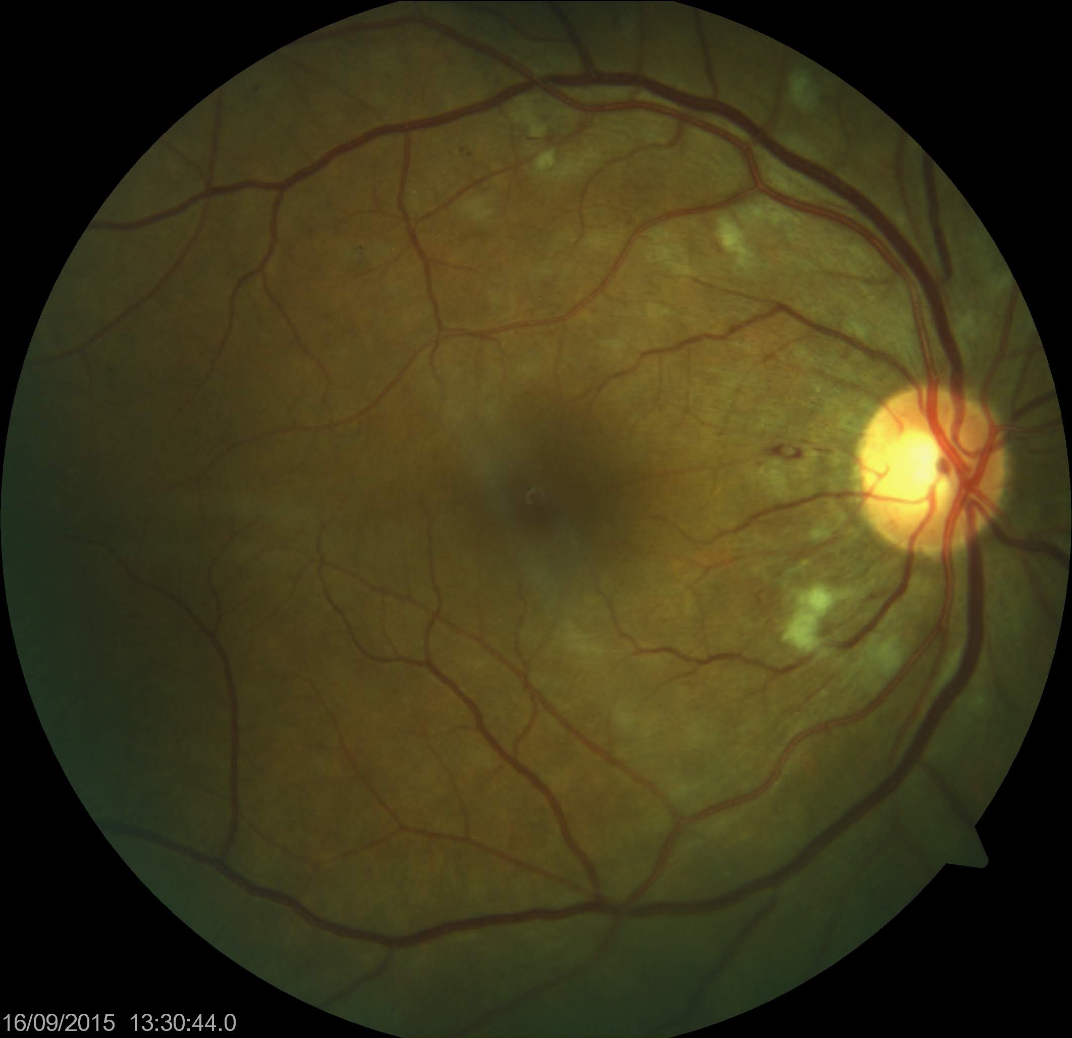 Interferon-Induced Retinopathy - MD Searchlight