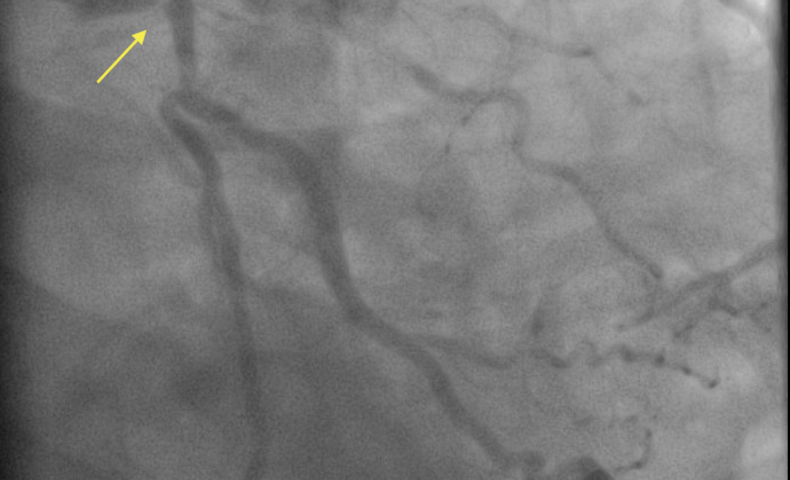 Coronary Angiography Archives - MD Searchlight