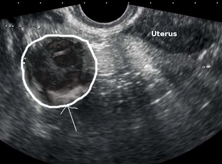 Tubo-Ovarian Abscess - MD Searchlight