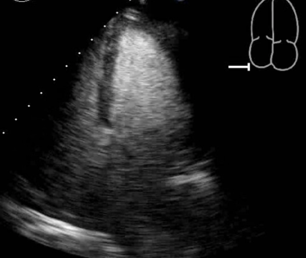 Mid-Ventricular Takotsubo Cardiomyopathy (Broken Heart Syndrome) - MD ...