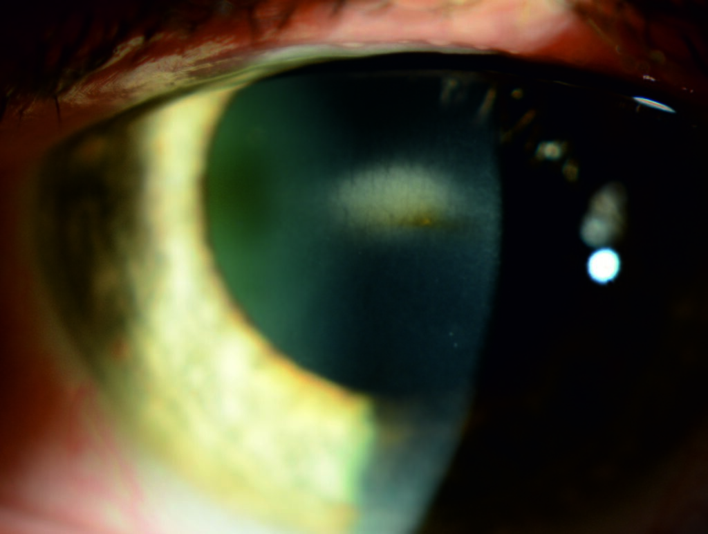 Keratoendotheliitis Fugax Hereditaria - MD Searchlight