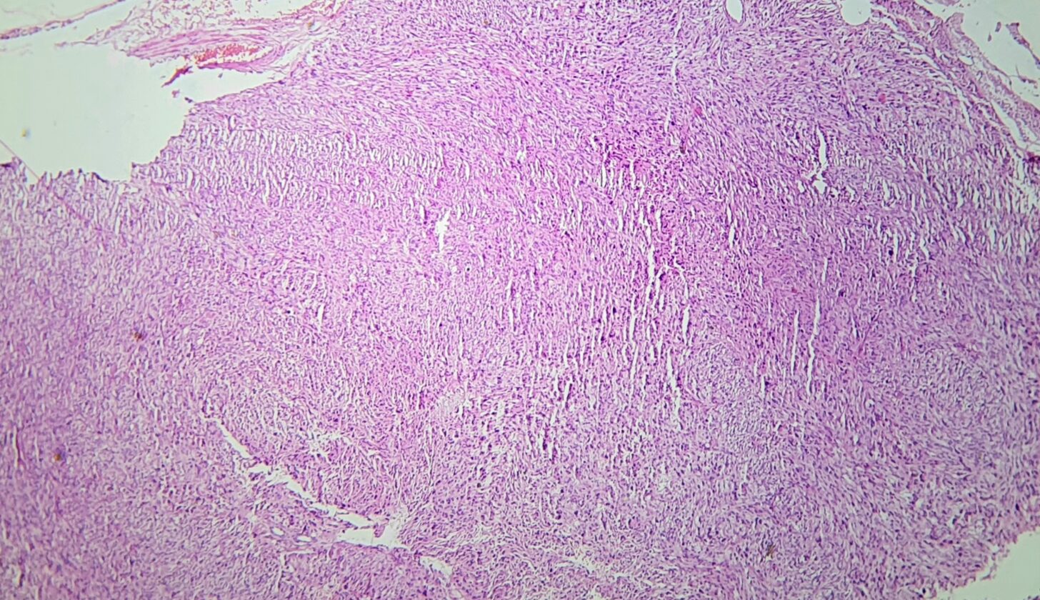 Undifferentiated Pleomorphic Sarcoma - MD Searchlight