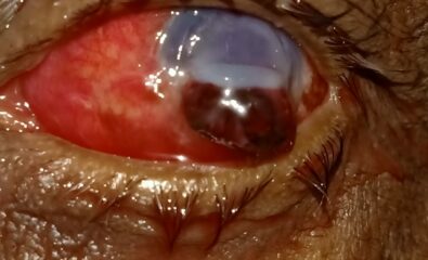 Scleral and Limbic Lacerations - MD Searchlight