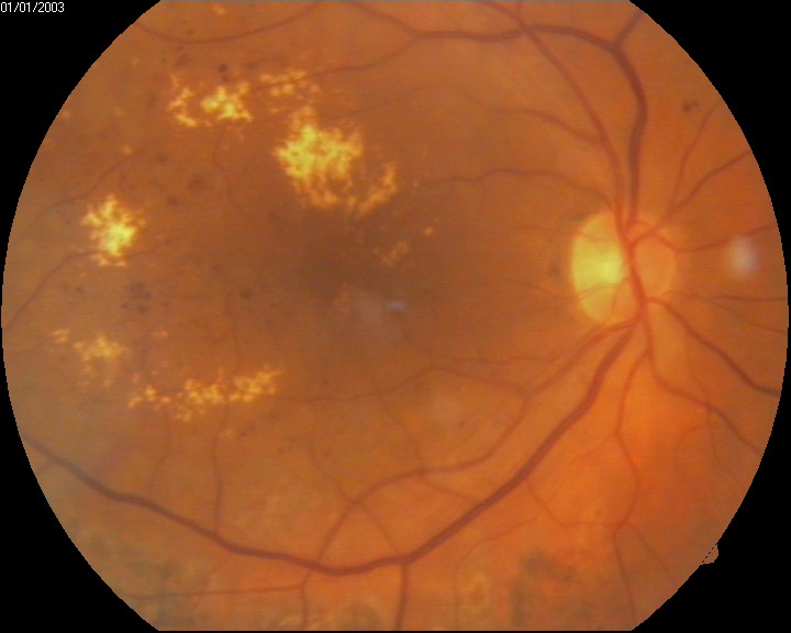 Macular Edema - MD Searchlight