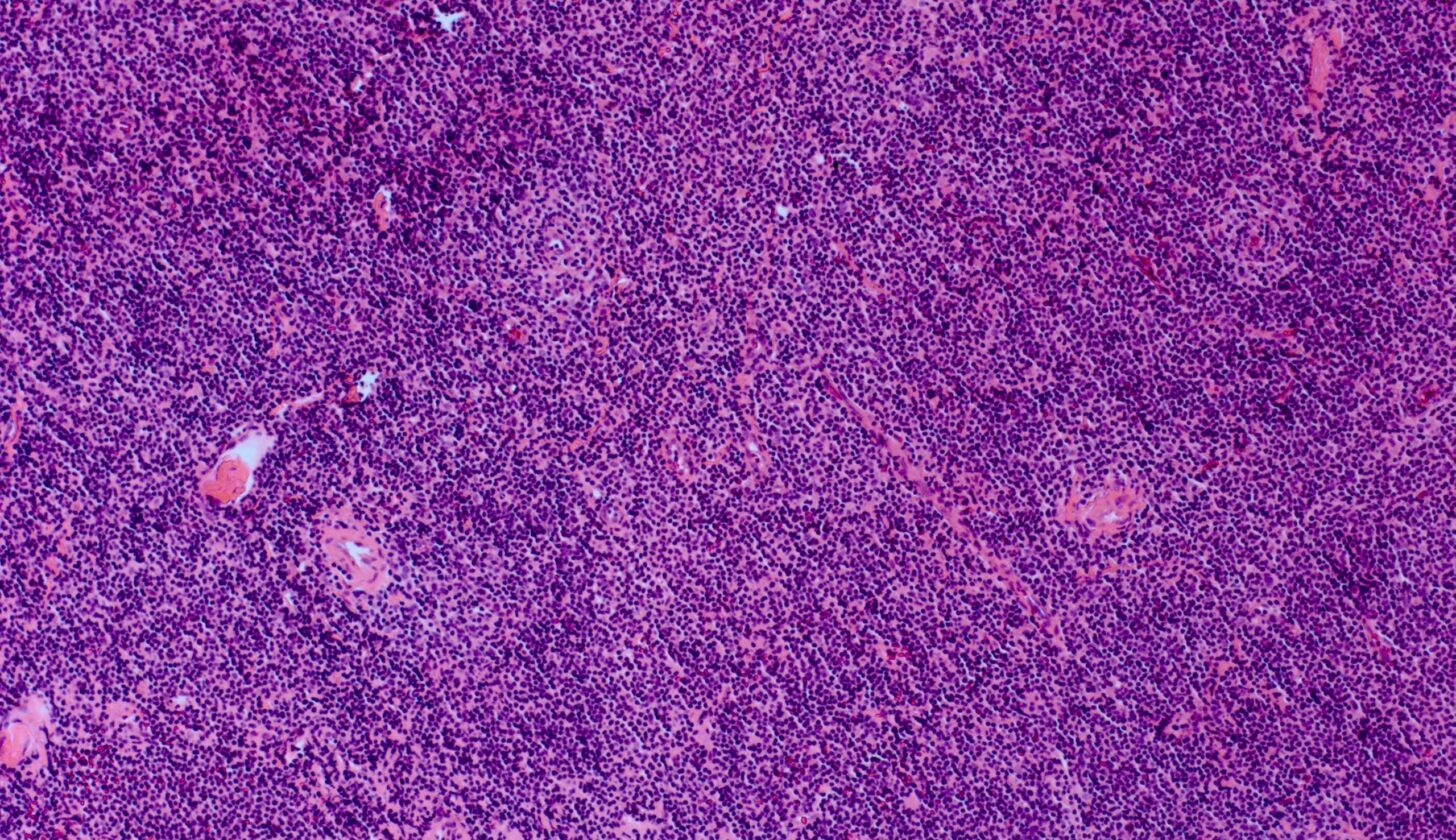 Benign Lacrimal Gland Tumors - MD Searchlight