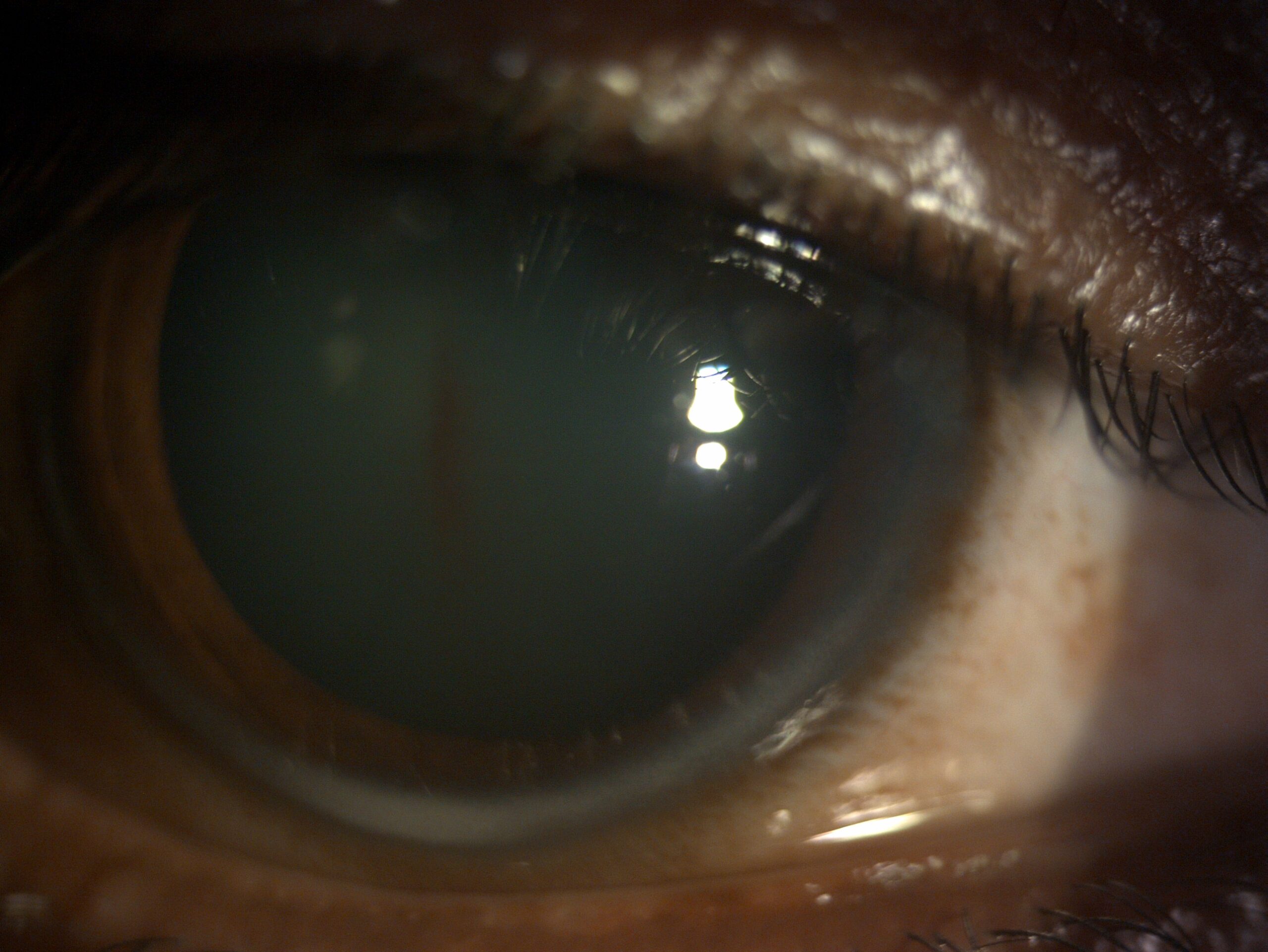 Pigment Dispersion Syndrome - MD Searchlight