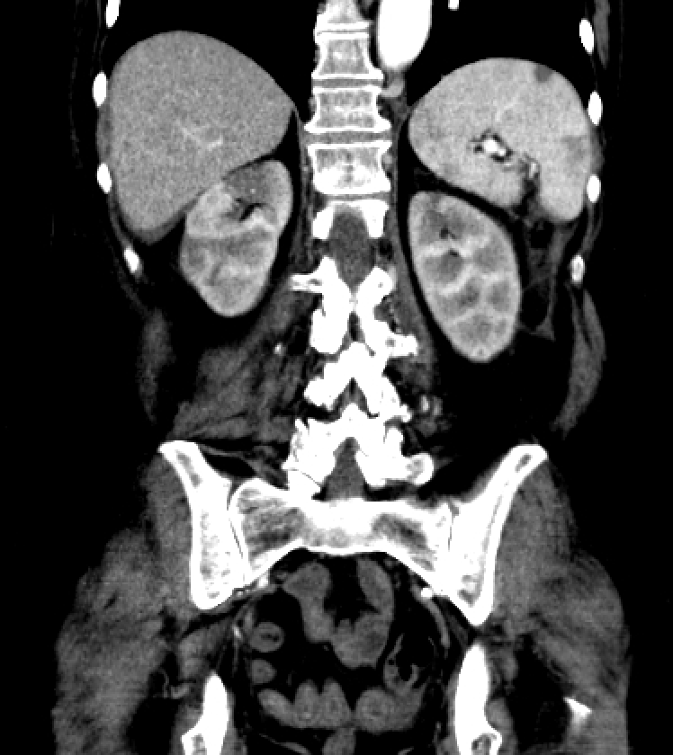 Renal Infarction - MD Searchlight
