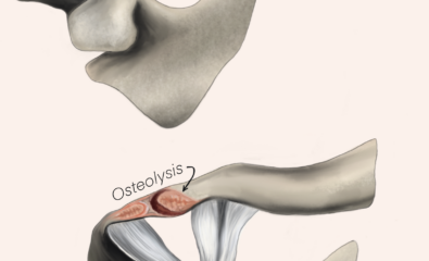 Distal Clavicular Osteolysis - MD Searchlight
