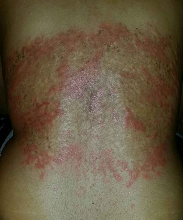 Prurigo Pigmentosa (Nagashima disease) - MD Searchlight