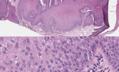 Trichilemmoma - MD Searchlight