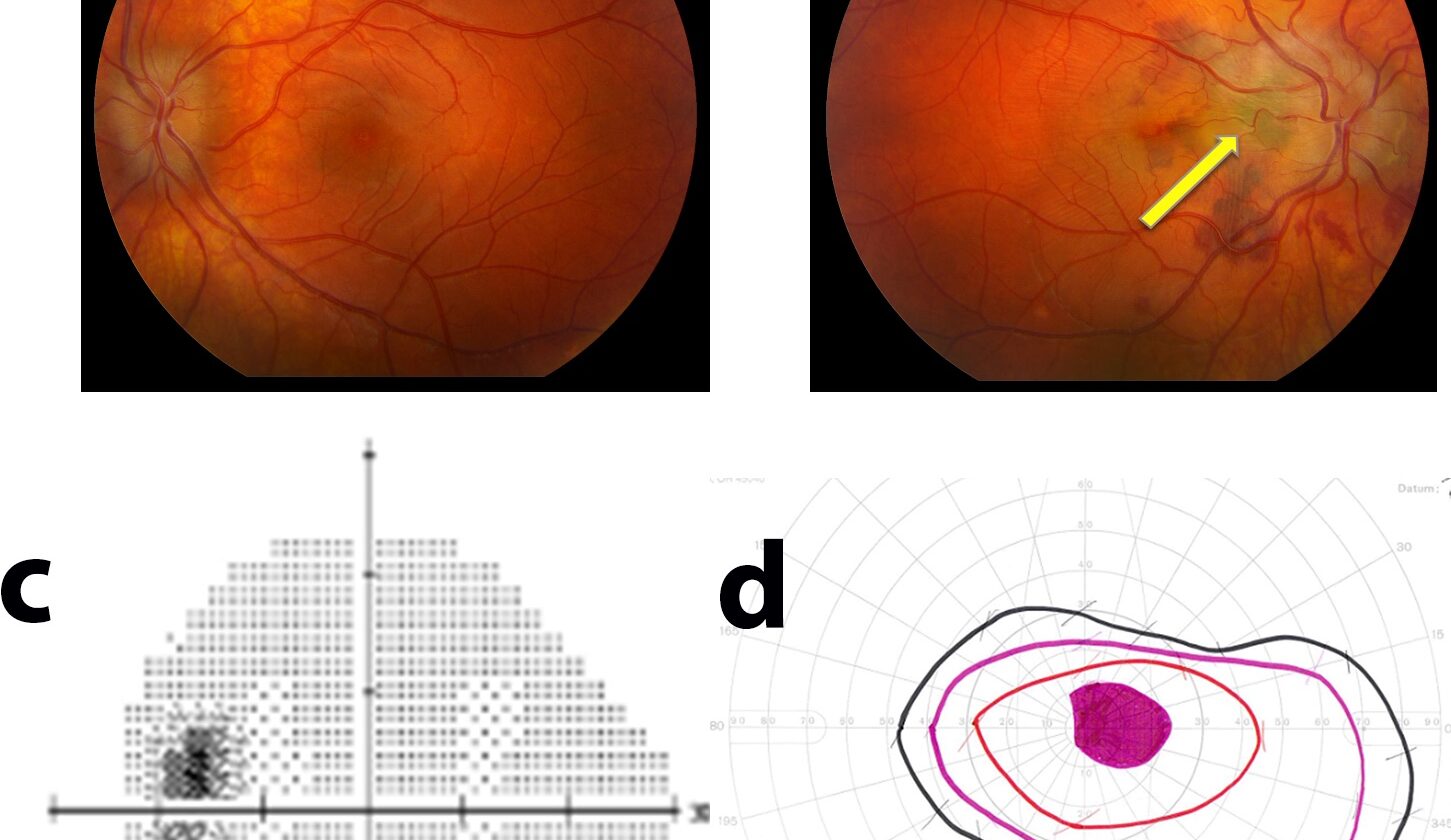 Intracranial Hypertension - MD Searchlight