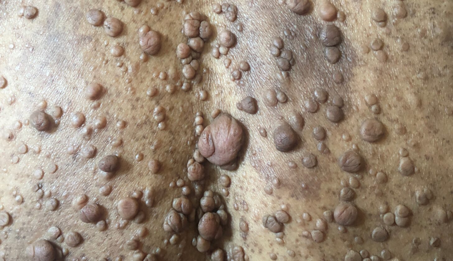 Neurofibroma - MD Searchlight