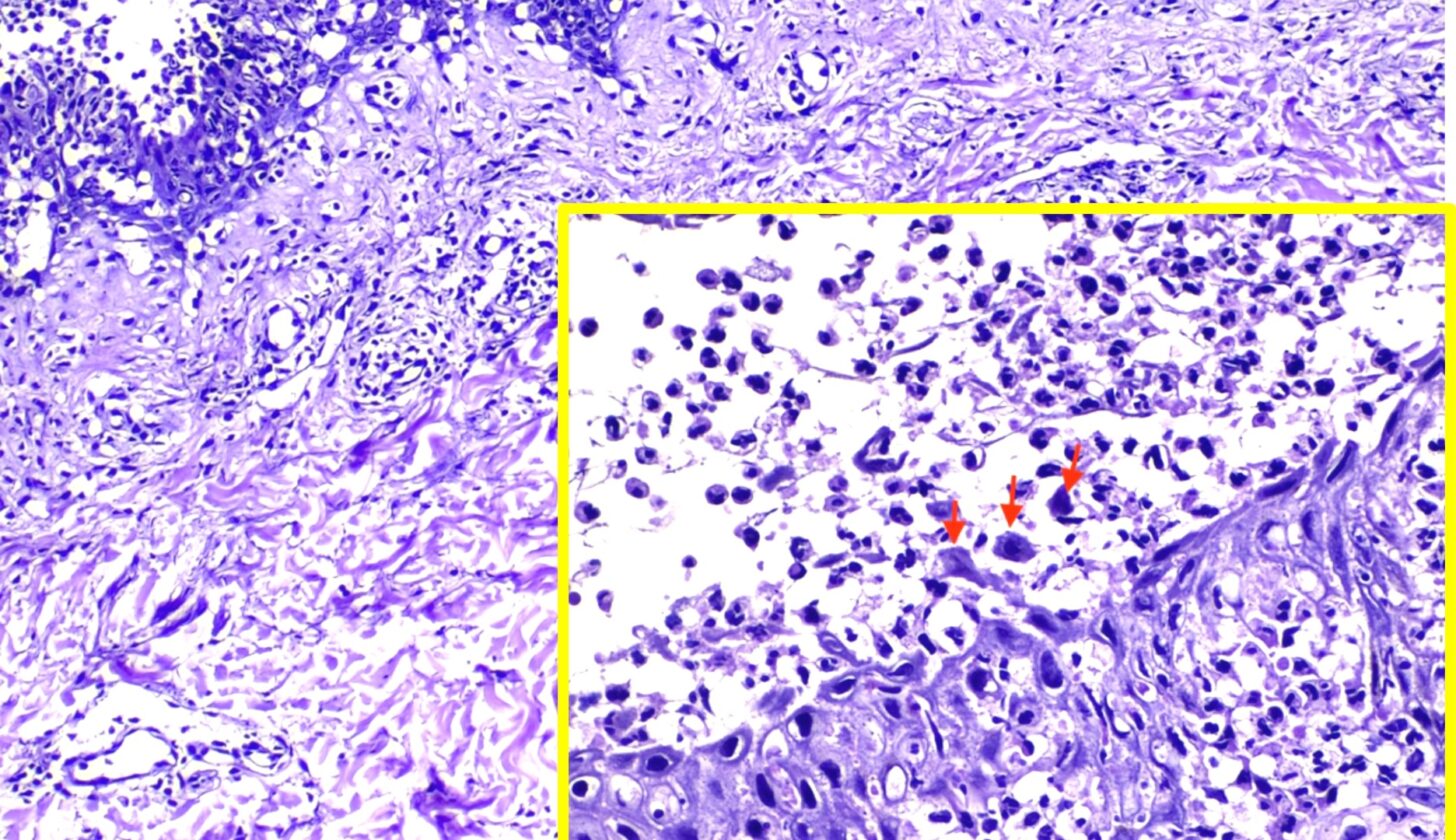 IgA Pemphigus - MD Searchlight