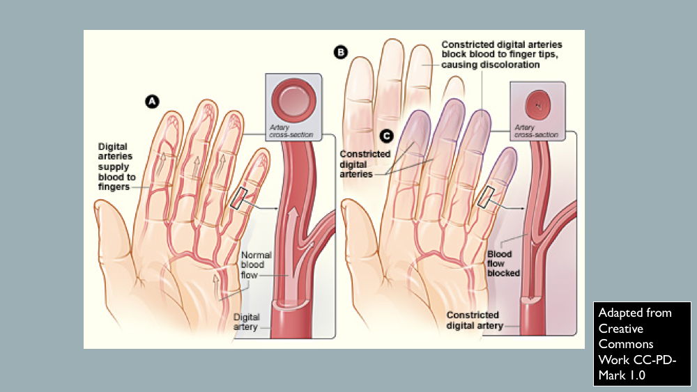 Raynaud Disease - MD Searchlight