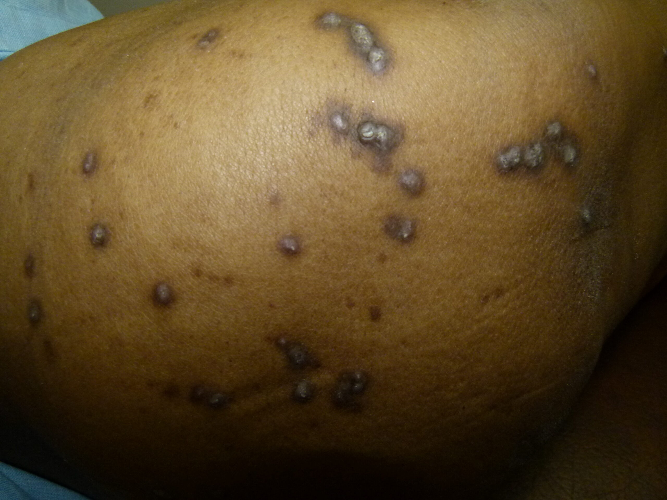 Acquired Perforating Dermatosis Treatment
