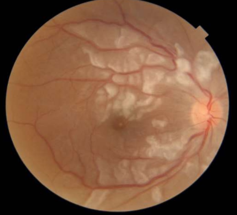 Purtscher Retinopathy - MD Searchlight