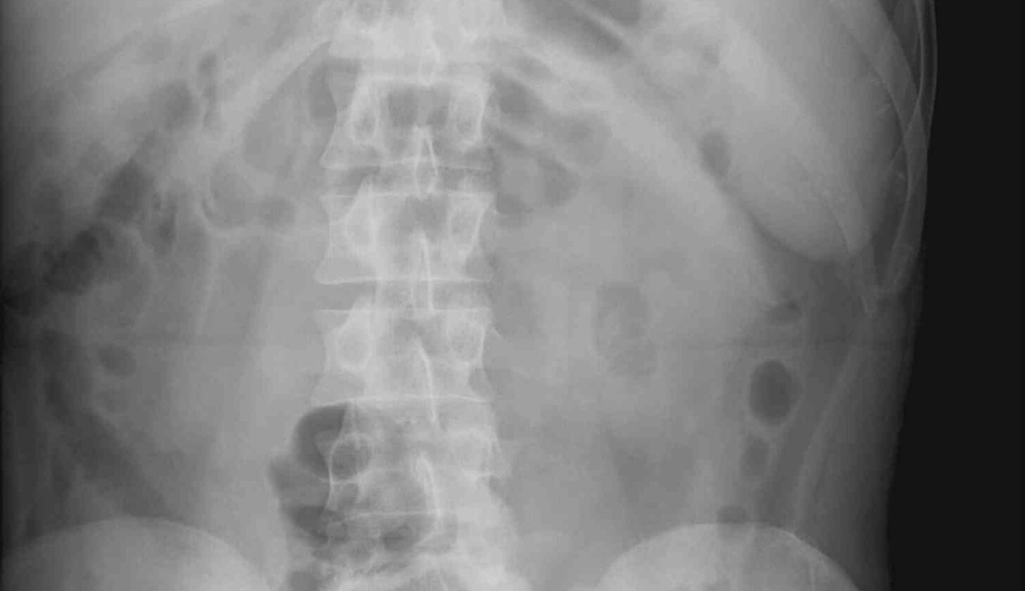 Splenomegaly - MD Searchlight