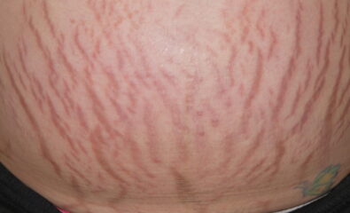 Stretch Marks - MD Searchlight