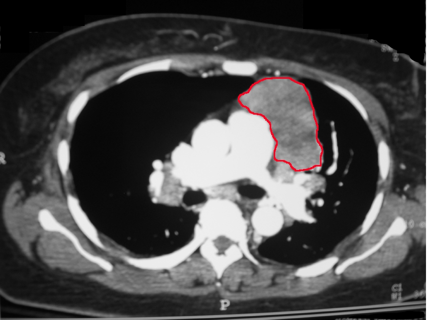 Thymoma - MD Searchlight