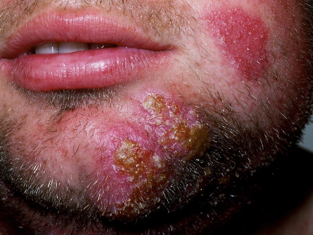 Tinea Barbae - MD Searchlight