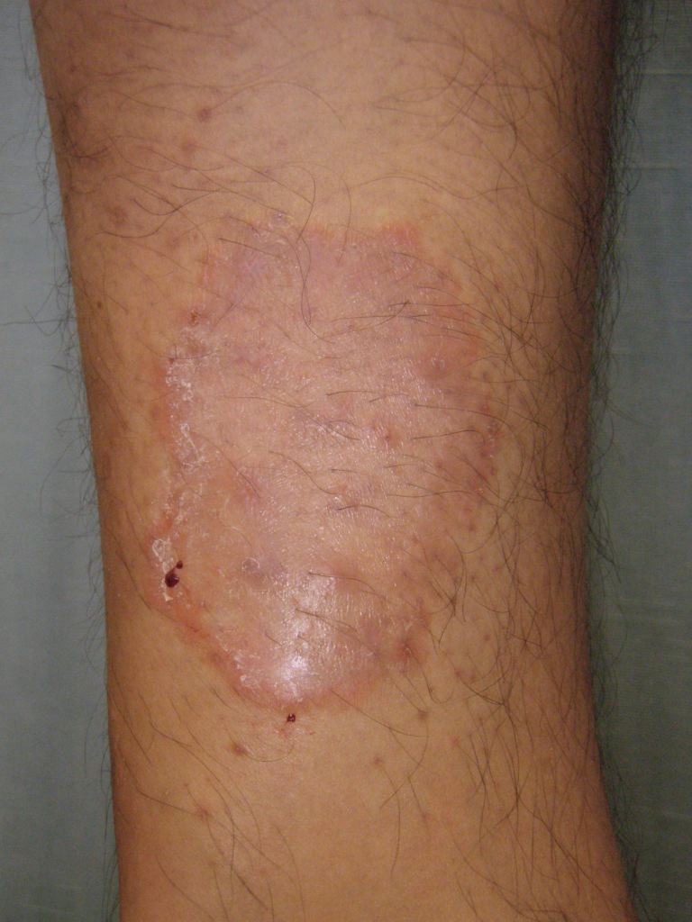Tinea Corporis - MD Searchlight
