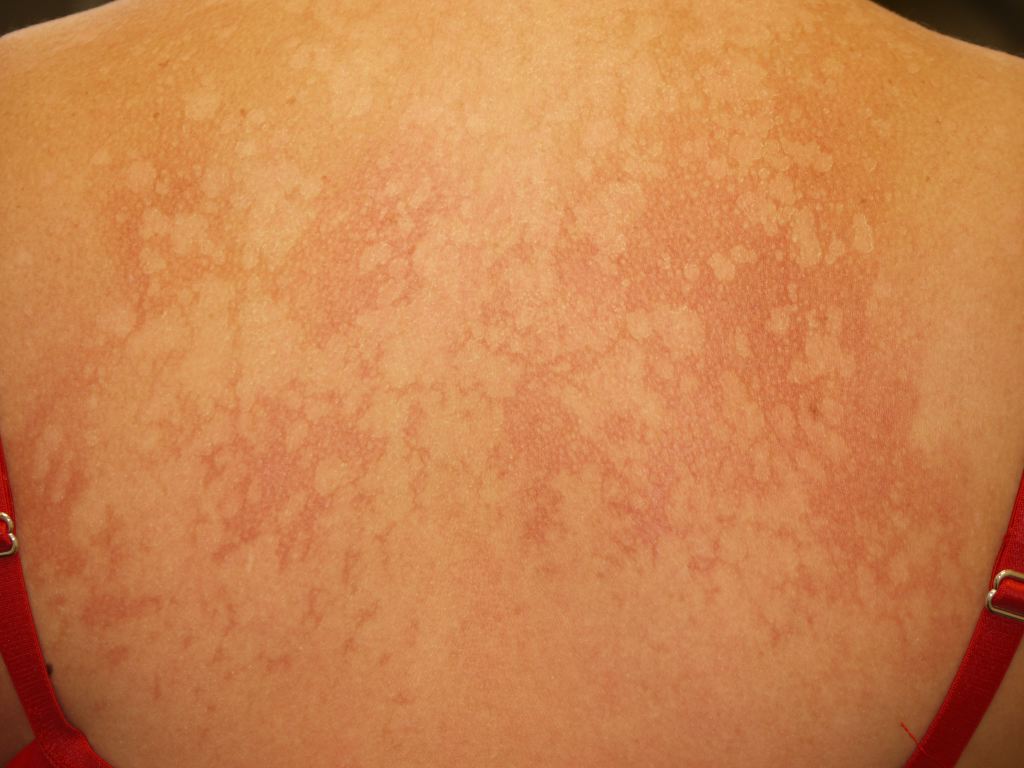 Tinea Versicolor - MD Searchlight
