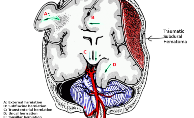 Uncal Herniation - MD Searchlight