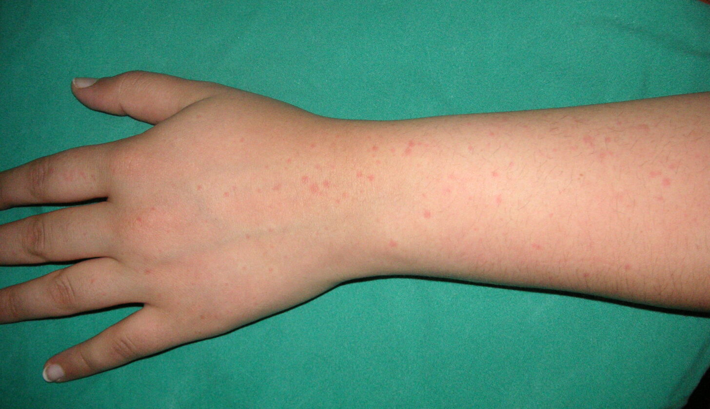 Solar Urticaria - MD Searchlight