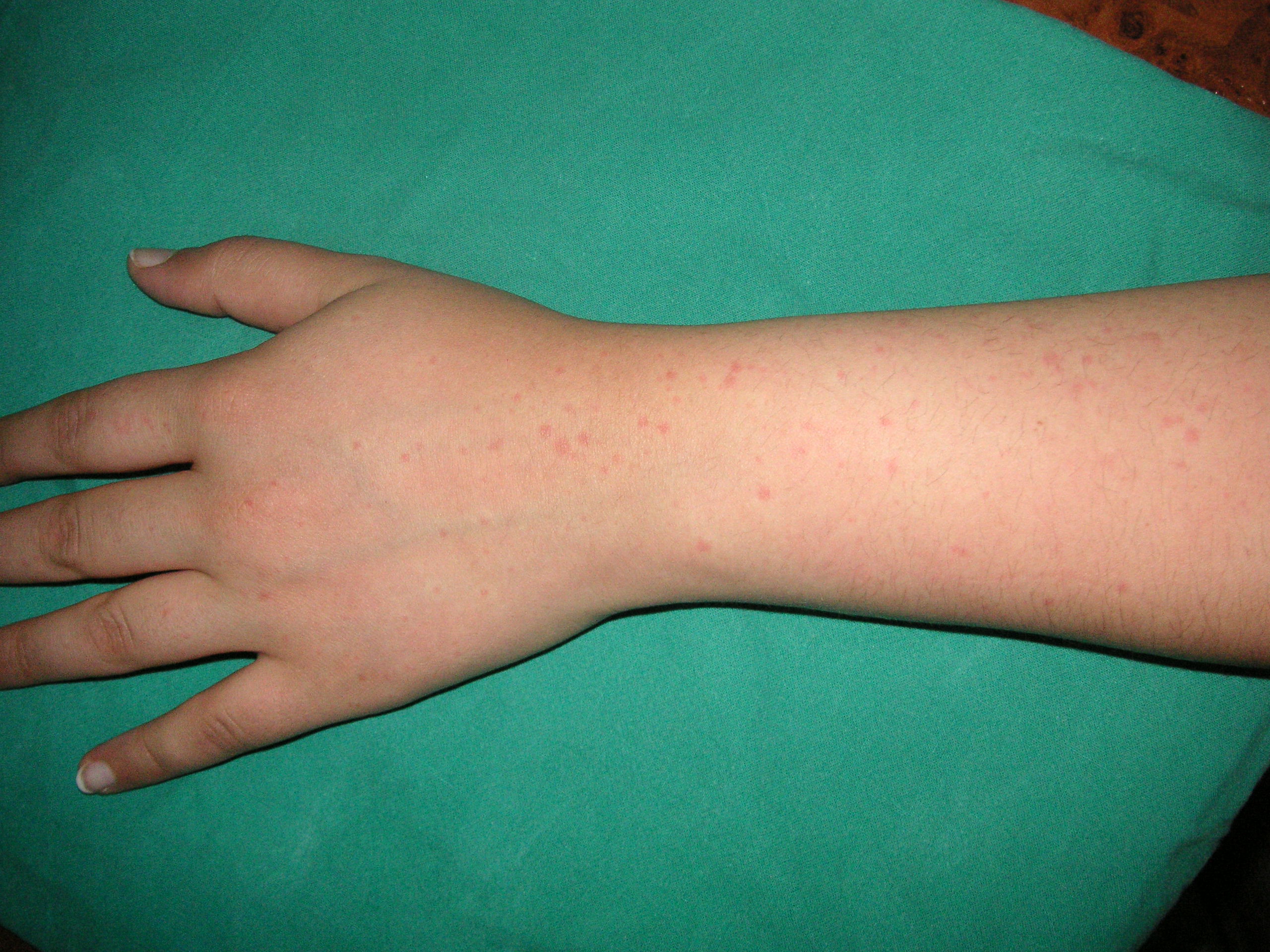 Solar Urticaria - MD Searchlight